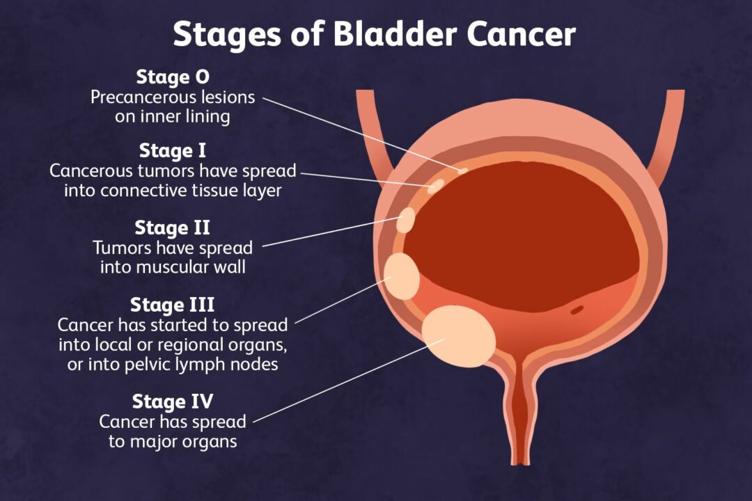 BLADDER REMOVAL NO LONGER ONLY OPTION FOR MUSCLE-INVASIVE BLADDER ...